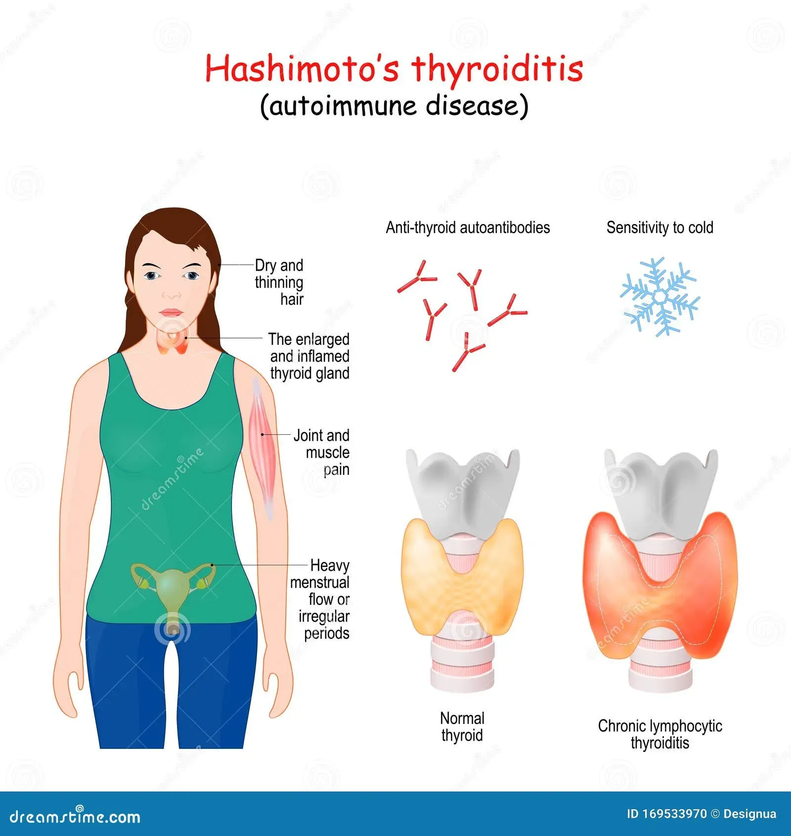 Hashimoto’s Thyroiditis: The Hidden Cause of Weight Gain